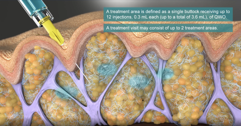 Answering Your Every Q on Qwo: Spring 2021’s Cellulite Rx Tx ...
